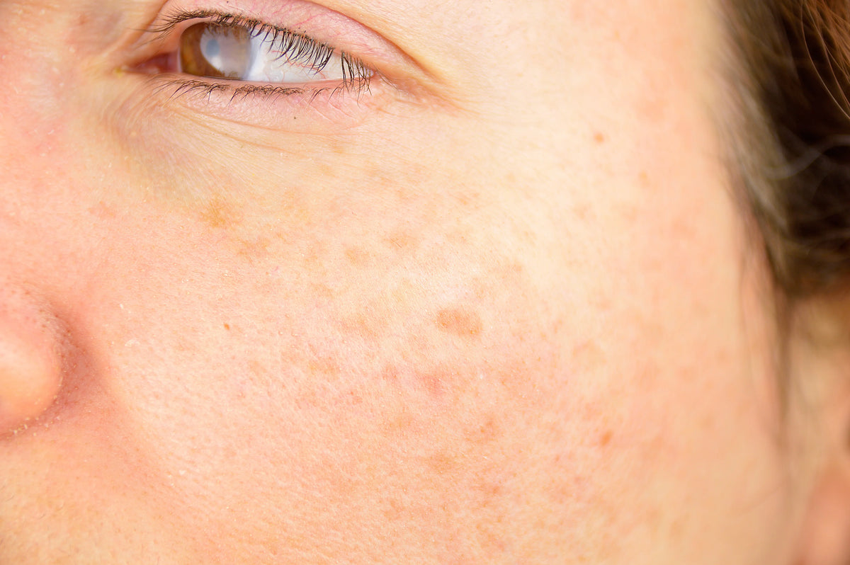 Melasma – Camelback